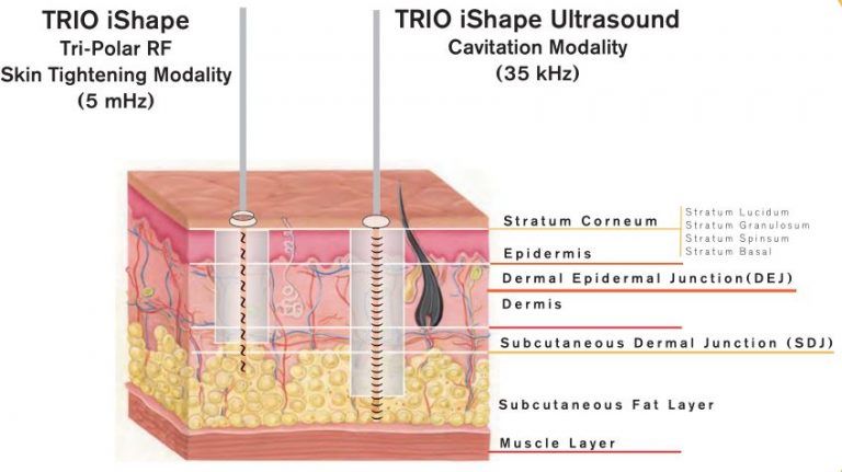 Radiofrequency (RF) wajah bisa mengencangkan pipi chubby? Pengalaman ...
